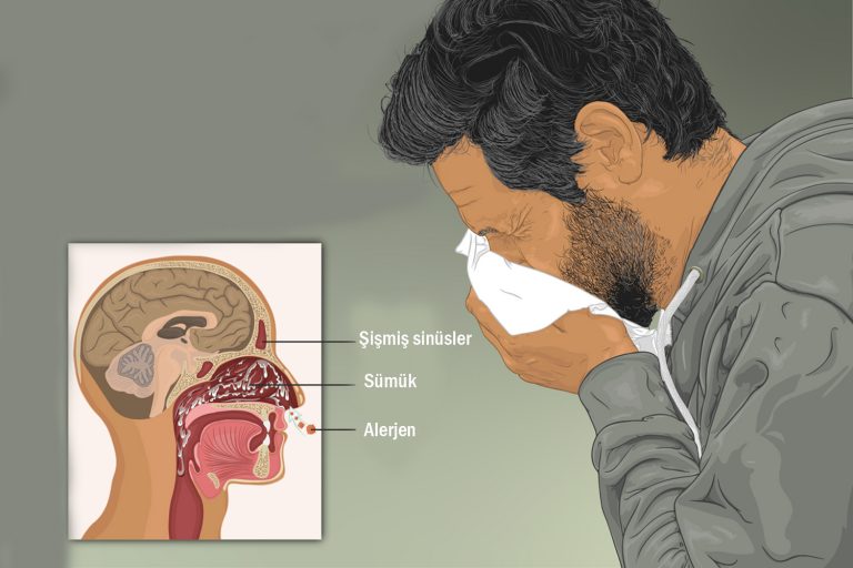 Alerjik Rinit ⋆ Op. Dr. Ömer Aşkıner | Rinoplasti ve Estetik Cerrahi